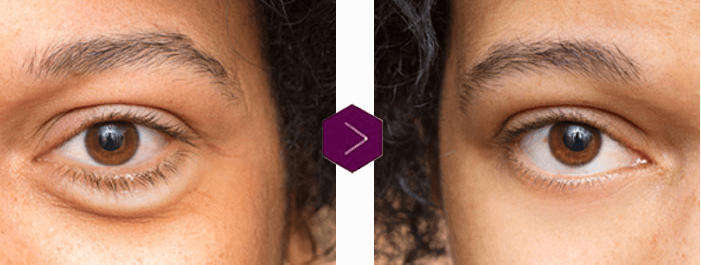 Best Under Eye Dark Circles Treatment in Hyderabad | Wowmen