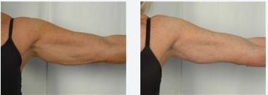 Arms Lift / Brachioplasty – Wowmen Skin Laser and Cosmetic Clinic in ...