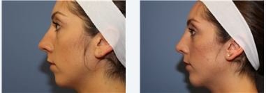 Jawline Augmentation & Square Face Correction – Wowmen Skin Laser and ...