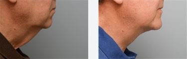 Jawline Augmentation & Square Face Correction – Wowmen Skin Laser and ...