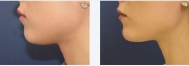 Jawline Augmentation & Square Face Correction – Wowmen Skin Laser and ...