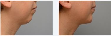 Jawline Augmentation & Square Face Correction – Wowmen Skin Laser and ...