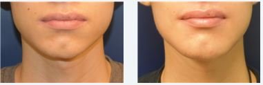 Jawline Augmentation & Square Face Correction – Wowmen Skin Laser and ...