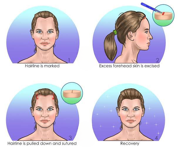 Forehead Reduction – Wowmen Skin Laser and Cosmetic Clinic in Hyderabad