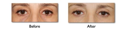 Best Under Eye Dark Circles Treatment in Hyderabad | Wowmen