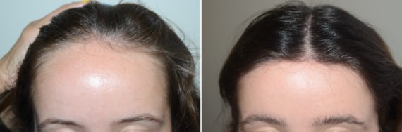 Forehead Reduction – Wowmen Skin Laser and Cosmetic Clinic in Hyderabad