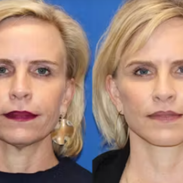 Facial Lipofilling / Fat Transfer – Wowmen Skin Laser and Cosmetic ...