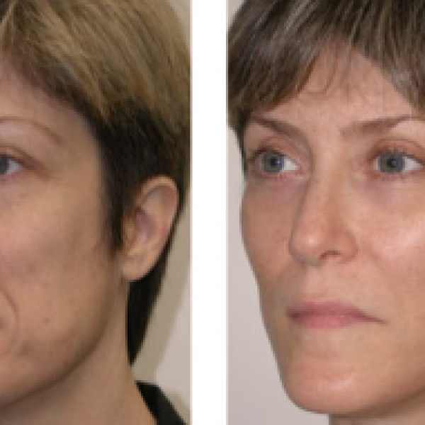 Best Facial Implants in Hyderabad | Wowmen Clinic