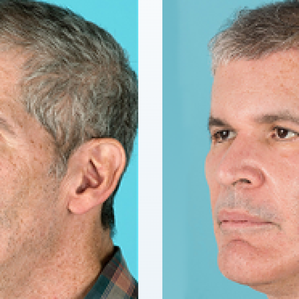 Best Facial Implants in Hyderabad | Wowmen Clinic