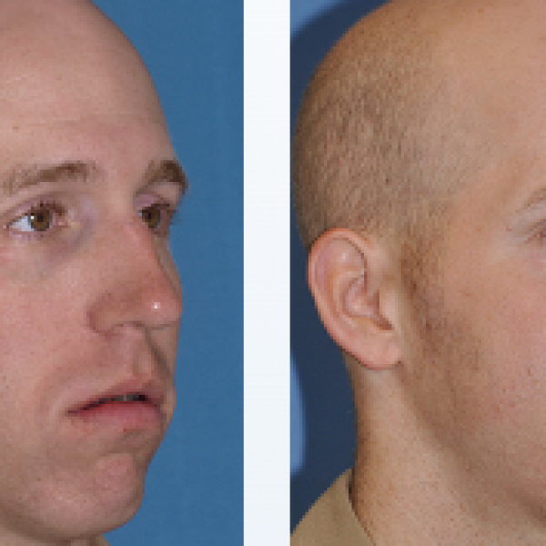 Best Facial Implants in Hyderabad | Wowmen Clinic